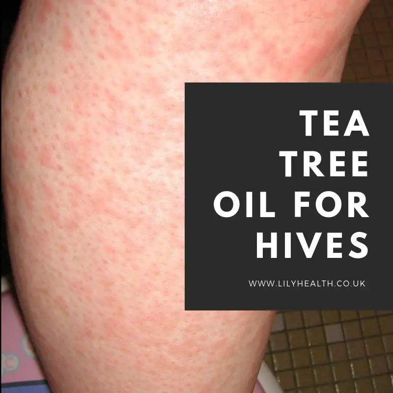 Say Goodbye to Hives: Discover the Surprising Benefits of Tea Tree Oil ...